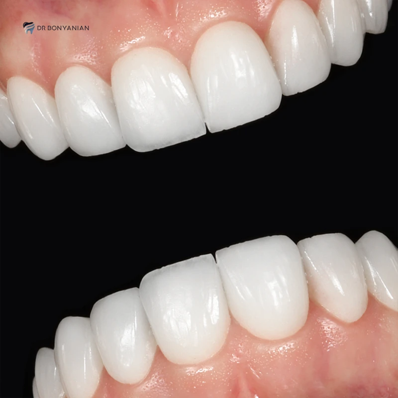 Dental Implant Fixture: Your Complete Guide (Types, Material & Care)