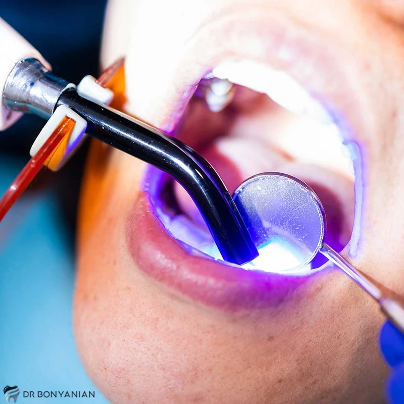 Dental Composite Longevity: How Long It Lasts & Factors Affecting It
